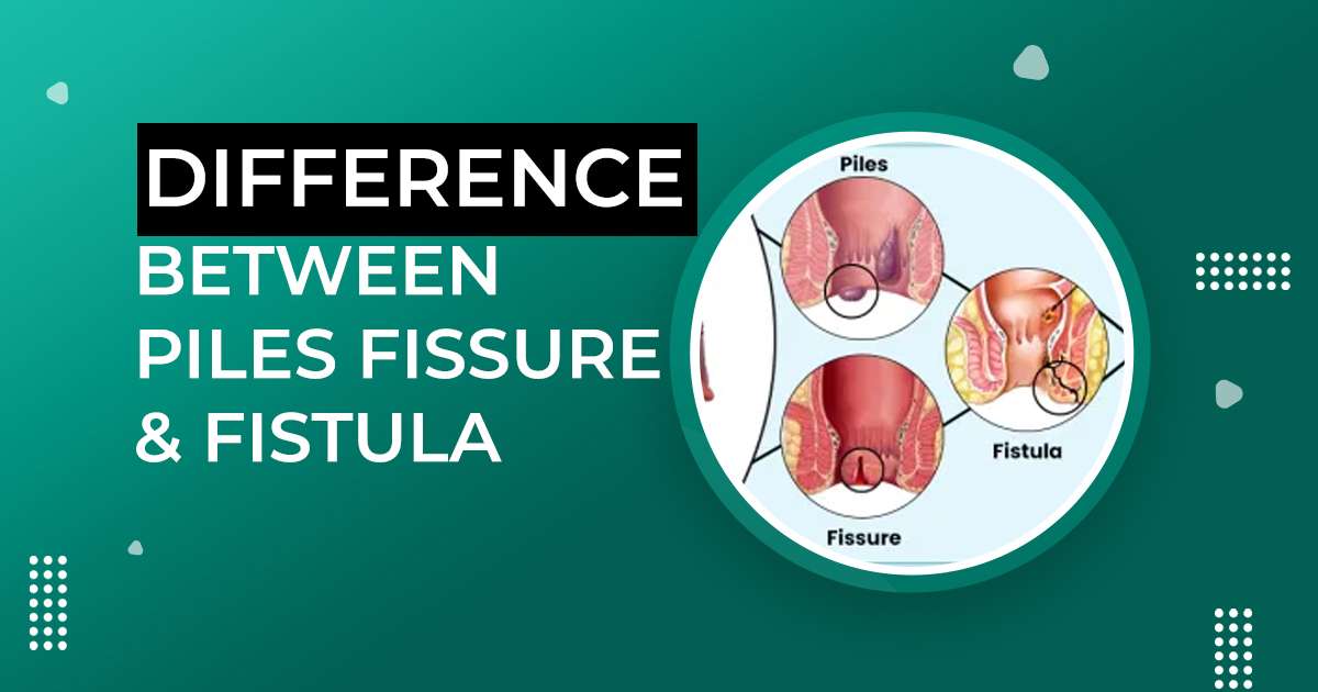 Difference Between Piles, Fistula, and Fissure: A Complete Guide ...