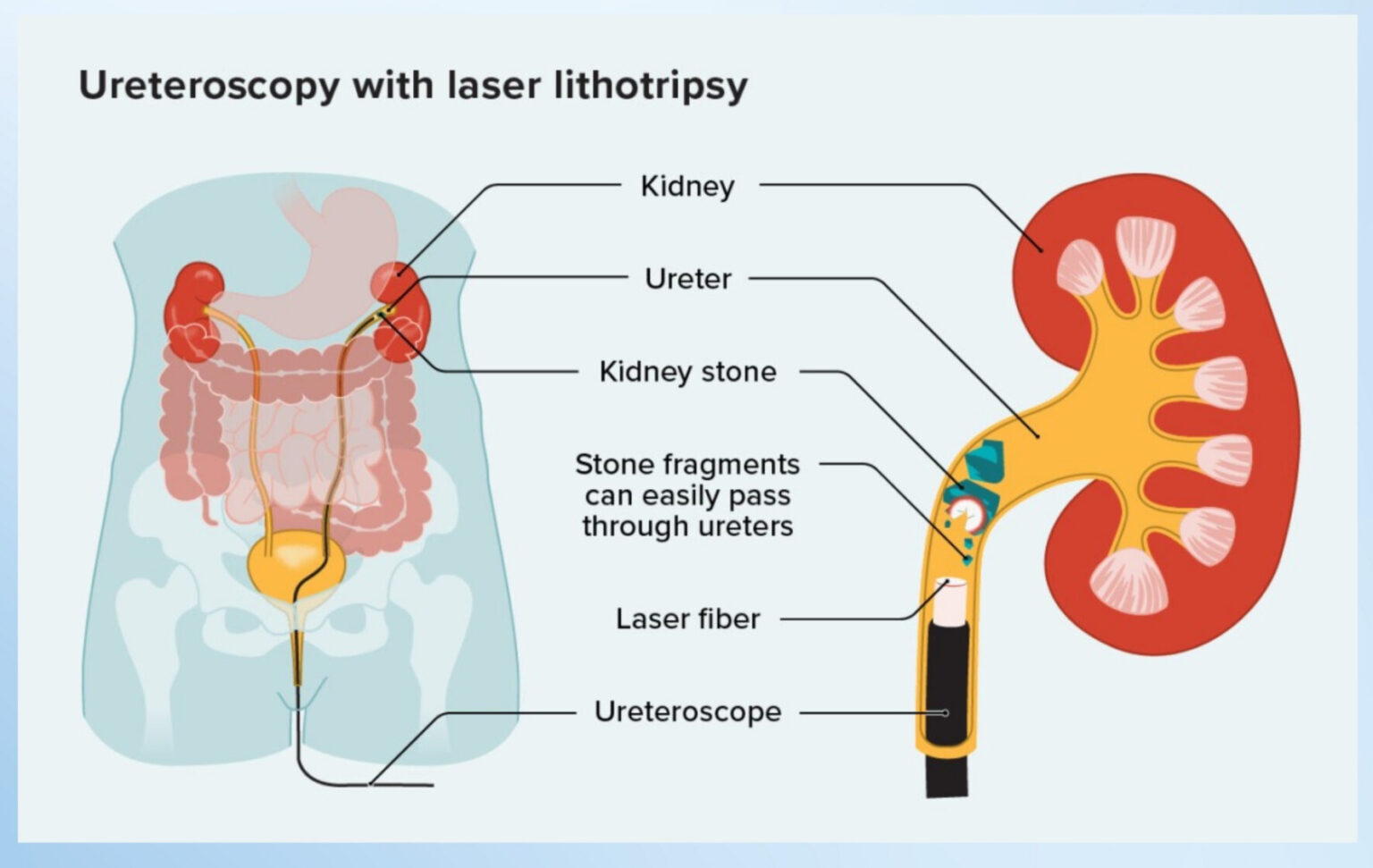 URSL Treatment for Kidney Stones | Safe Stone Removal